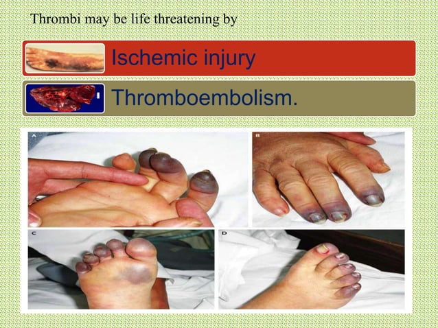 Thrombosis - Pathology by Dr.Pawan | PPTX | Blood Disorders | Diseases ...