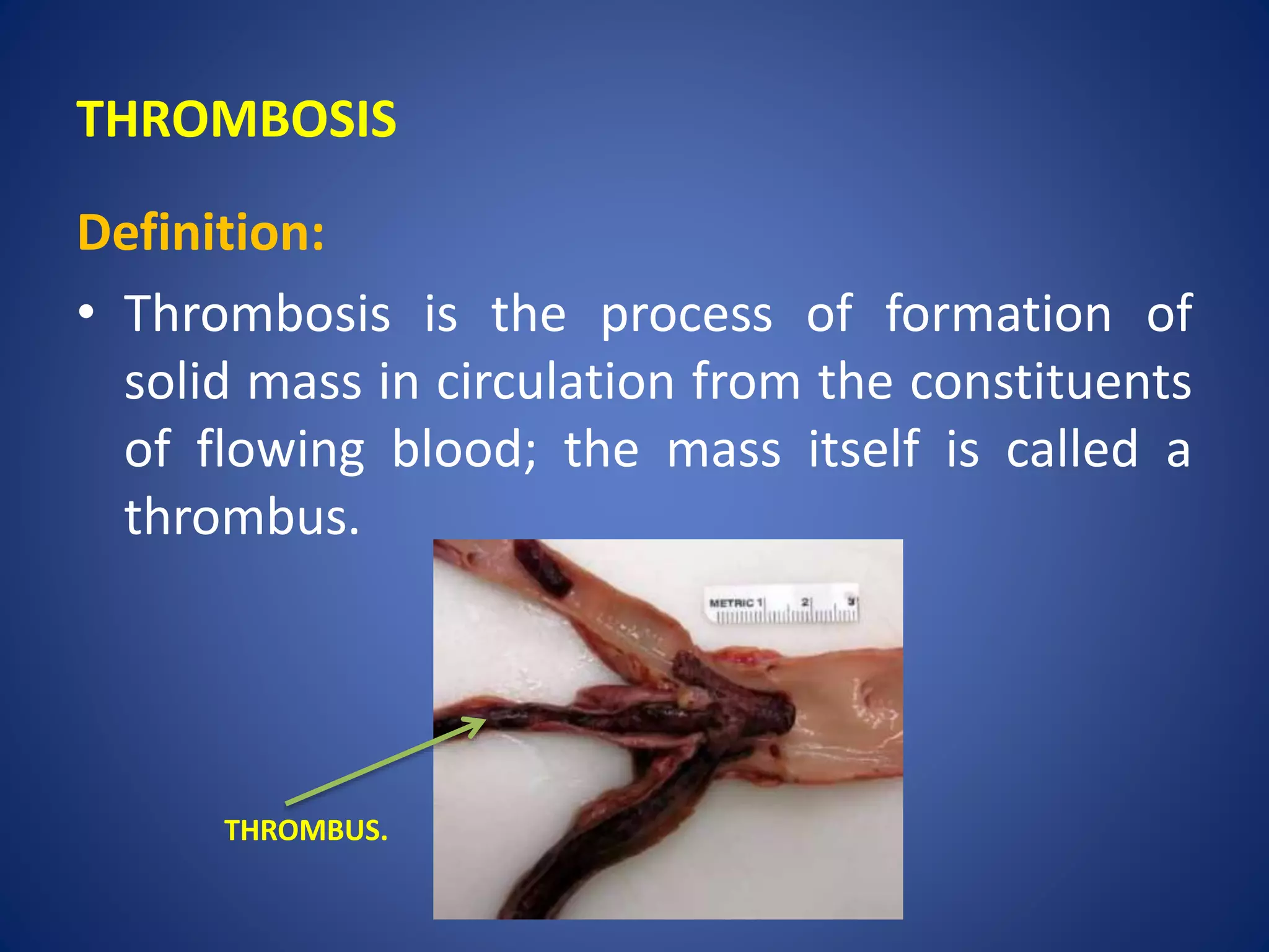 Thrombosis complete | PPTX