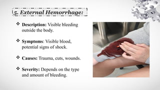 Thrombosis, EDEMA.pptx general pathology | PPTX