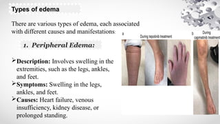 Thrombosis, EDEMA.pptx general pathology | PPTX