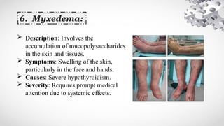 Thrombosis, EDEMA.pptx general pathology | PPTX