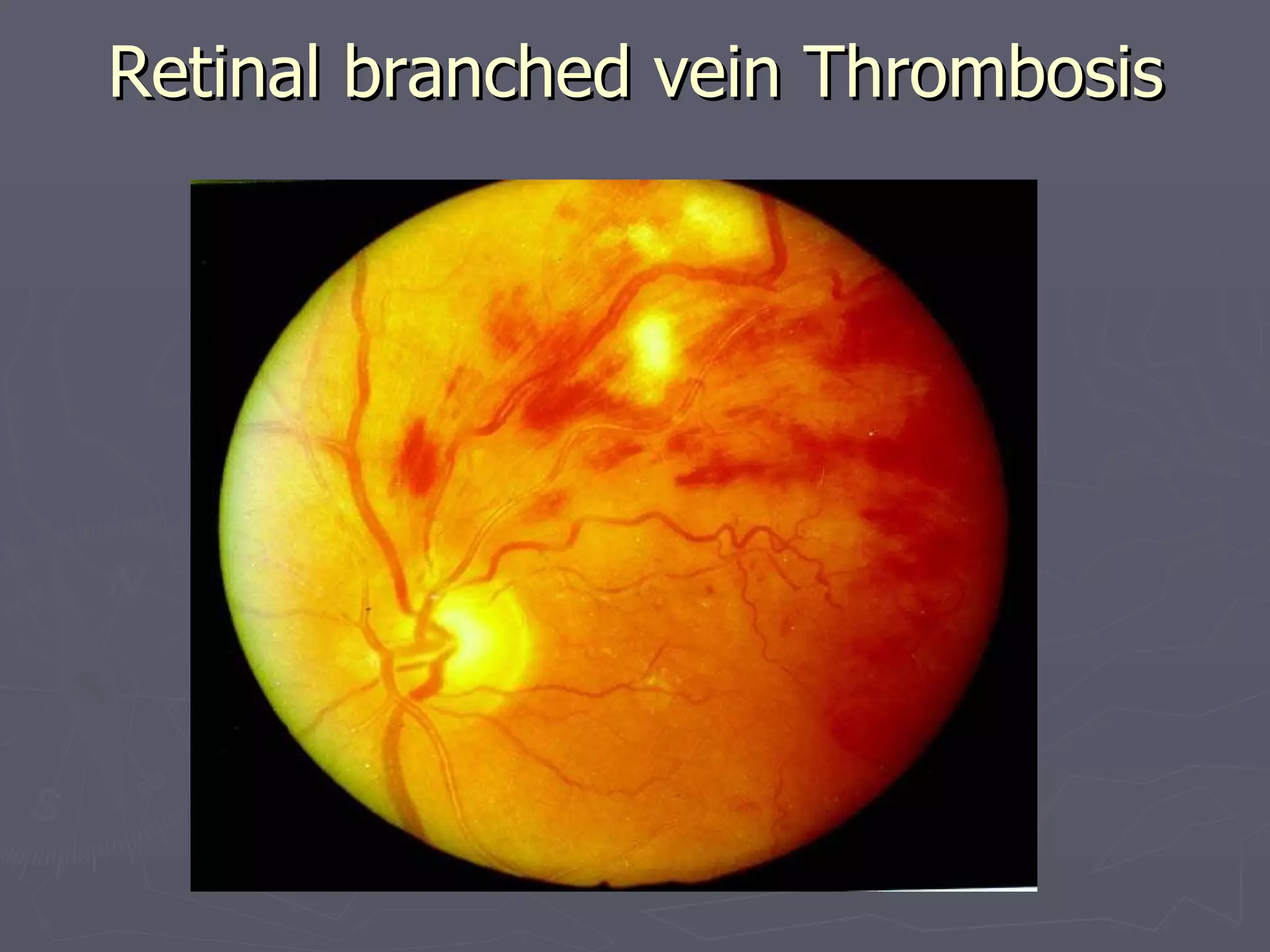 Thrombosis & embolism | PPT