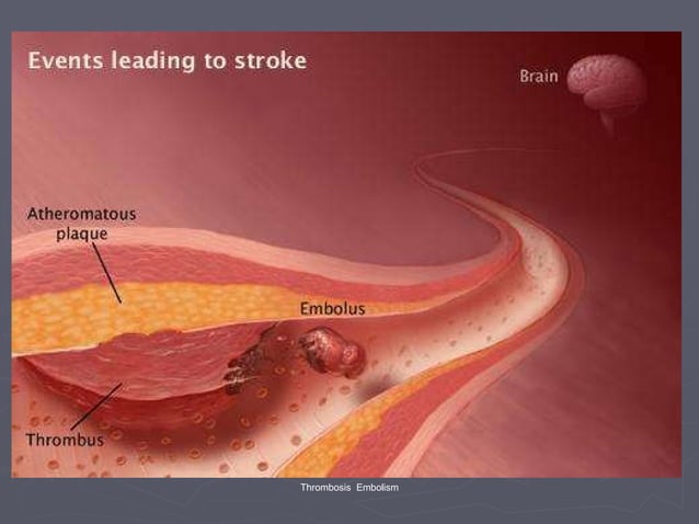 Thrombosis & embolism | PPT | Blood Disorders | Diseases and Conditions