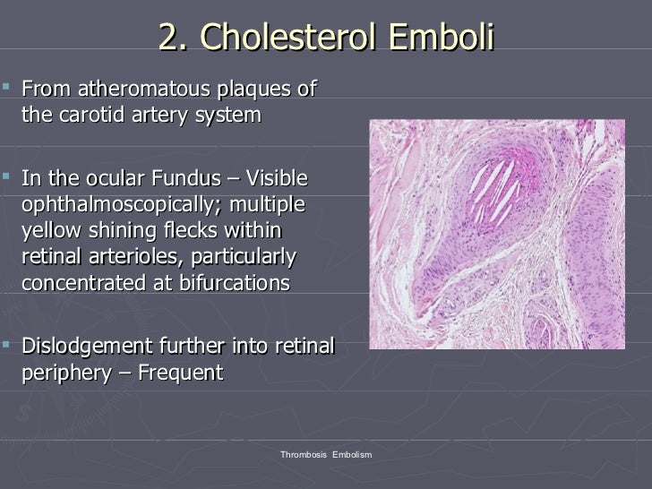 Thrombosis & embolism