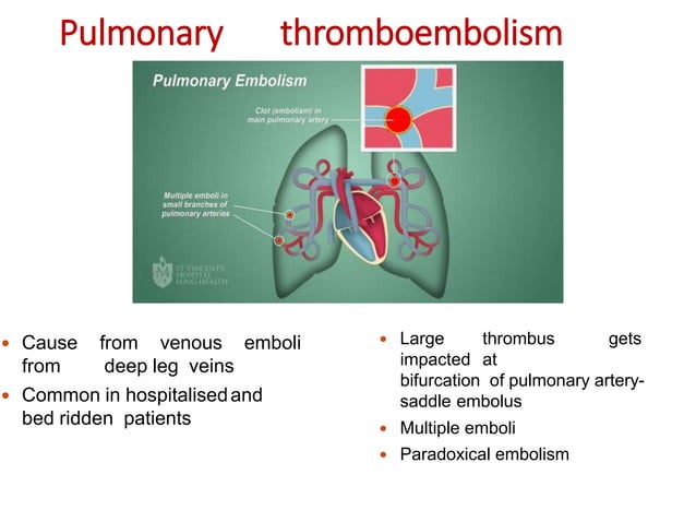 thrombosis embolism.pptx