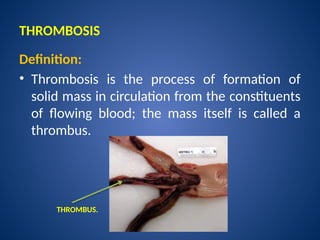 THROMBOSIS & EMBOLISM pathology ....pptx