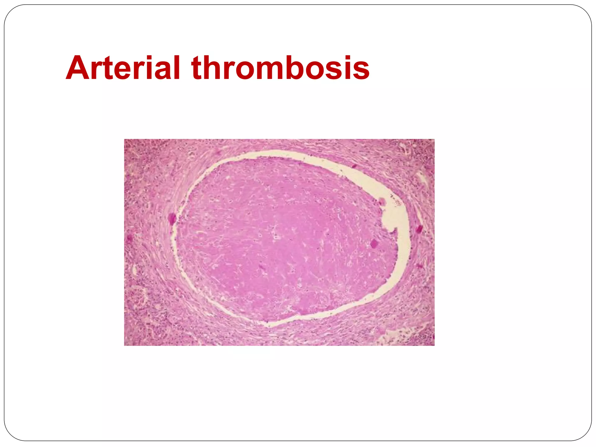 Thrombosis, embolism and infarction | PPTX