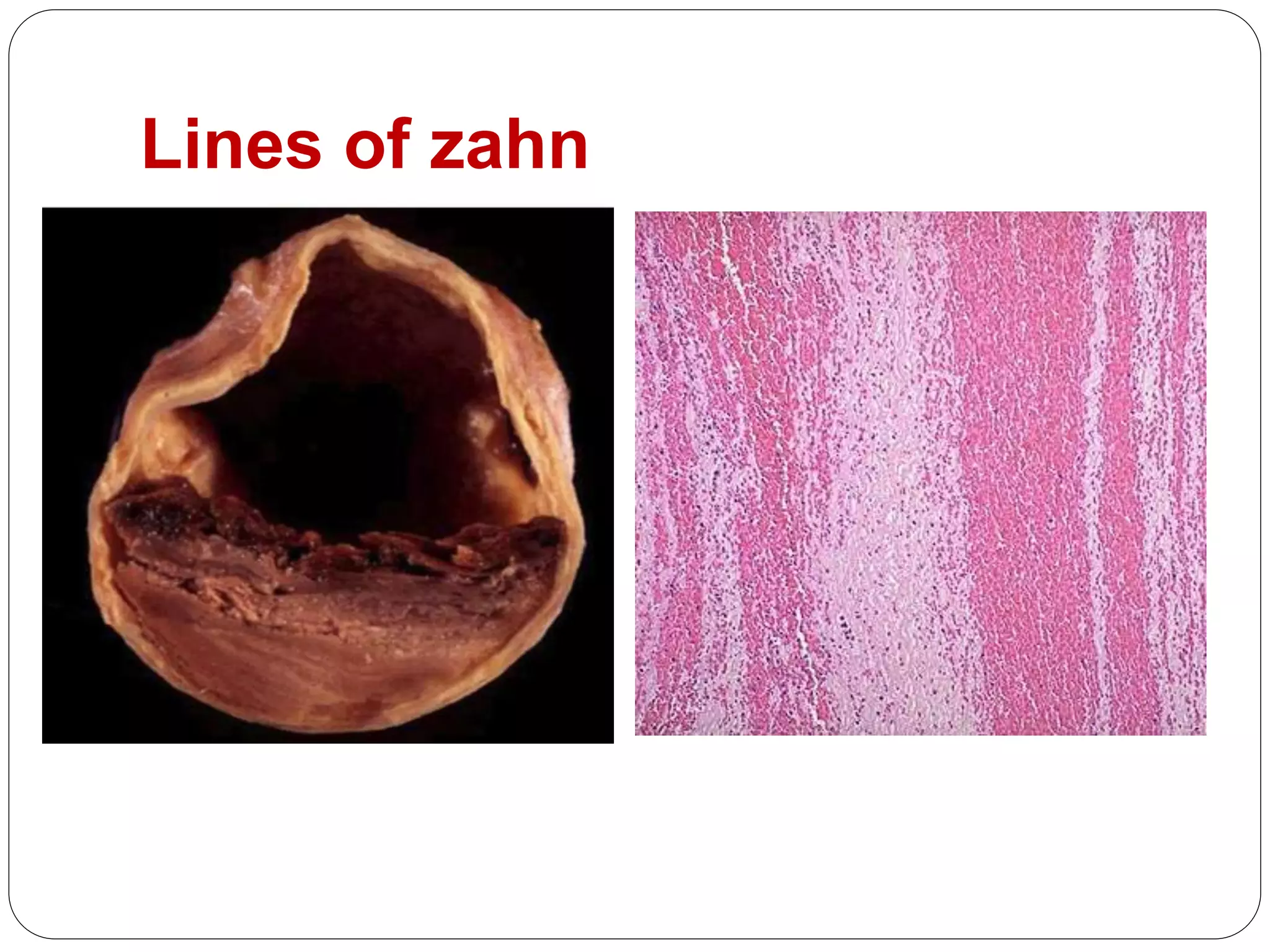 Thrombosis, embolism and infarction