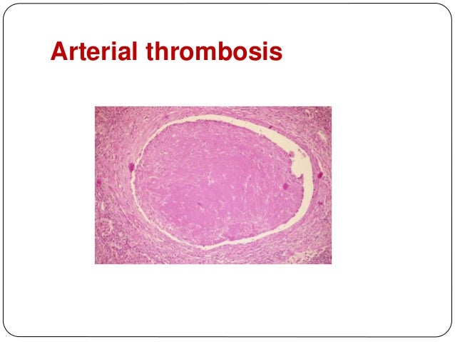Thrombosis Embolism And Infarction