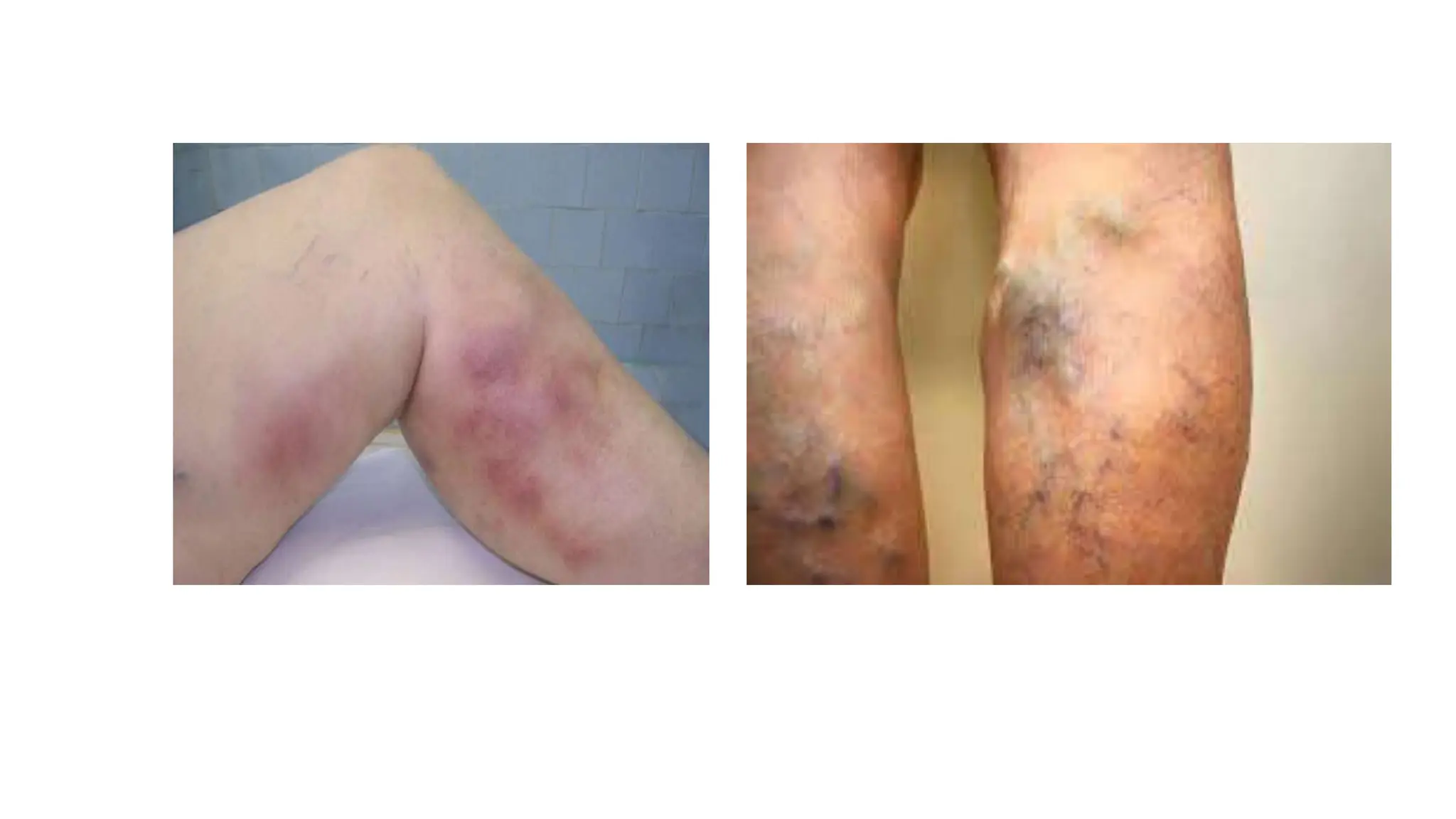 THROMBOSIS, PHLEBITIS, PHLEBOTHROMBOSIS.pptx