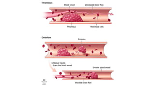 THROMBOSIS, PHLEBITIS, PHLEBOTHROMBOSIS.pptx