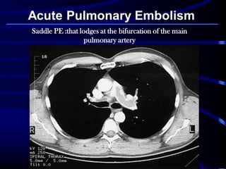 Thrombotic and nonthrombotic pulmonary embolism | PDF