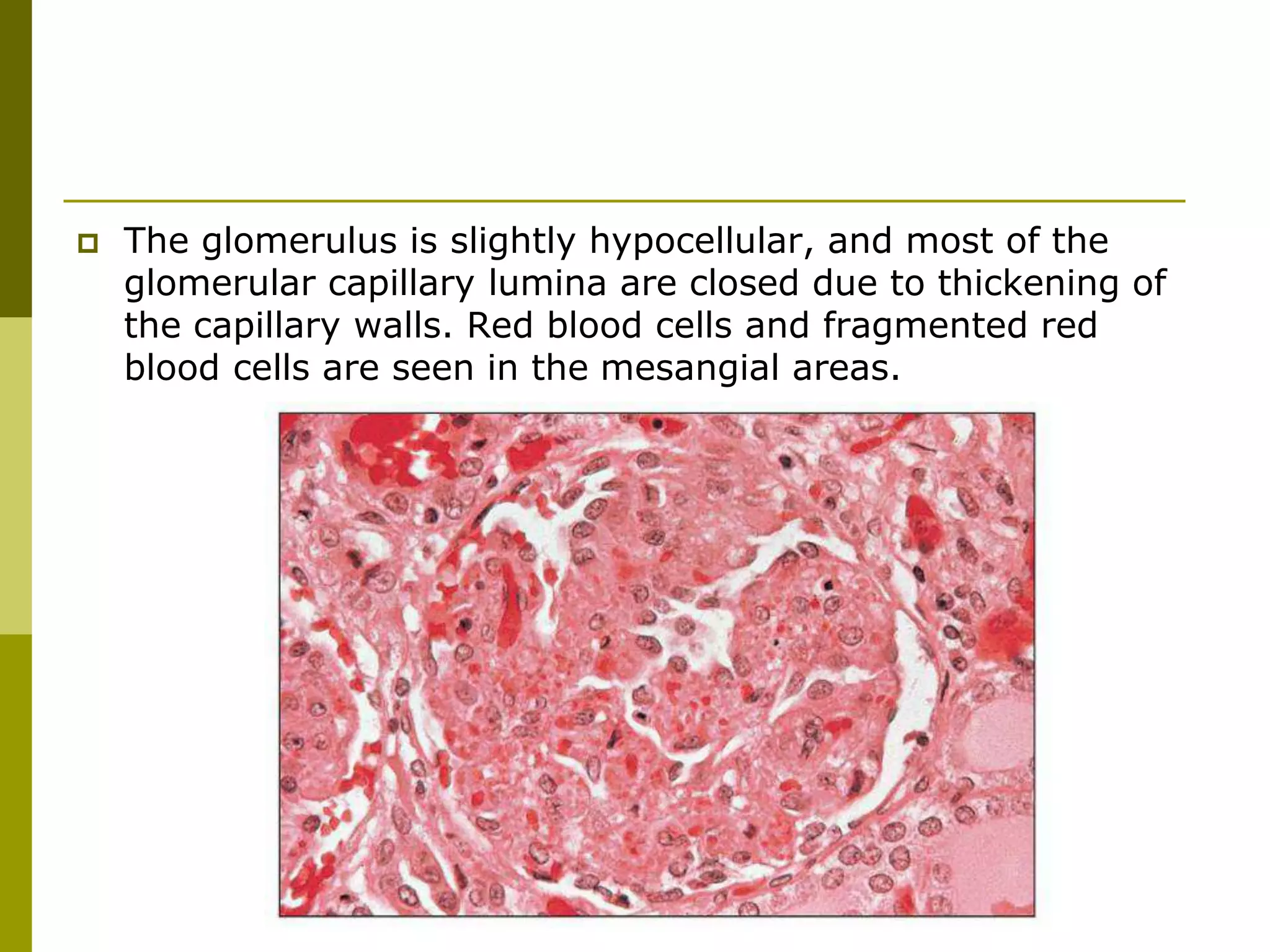 Thrombotic microangiopathy | PPTX