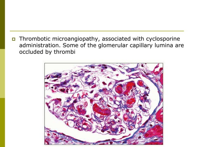 Thrombotic microangiopathy | PPTX | Blood Disorders | Diseases and ...