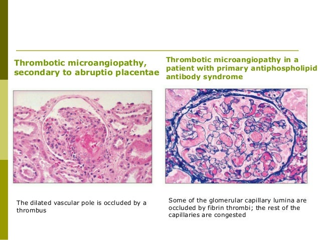 Thrombotic microangiopathy