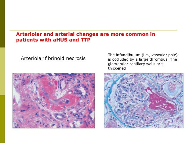 Thrombotic microangiopathy