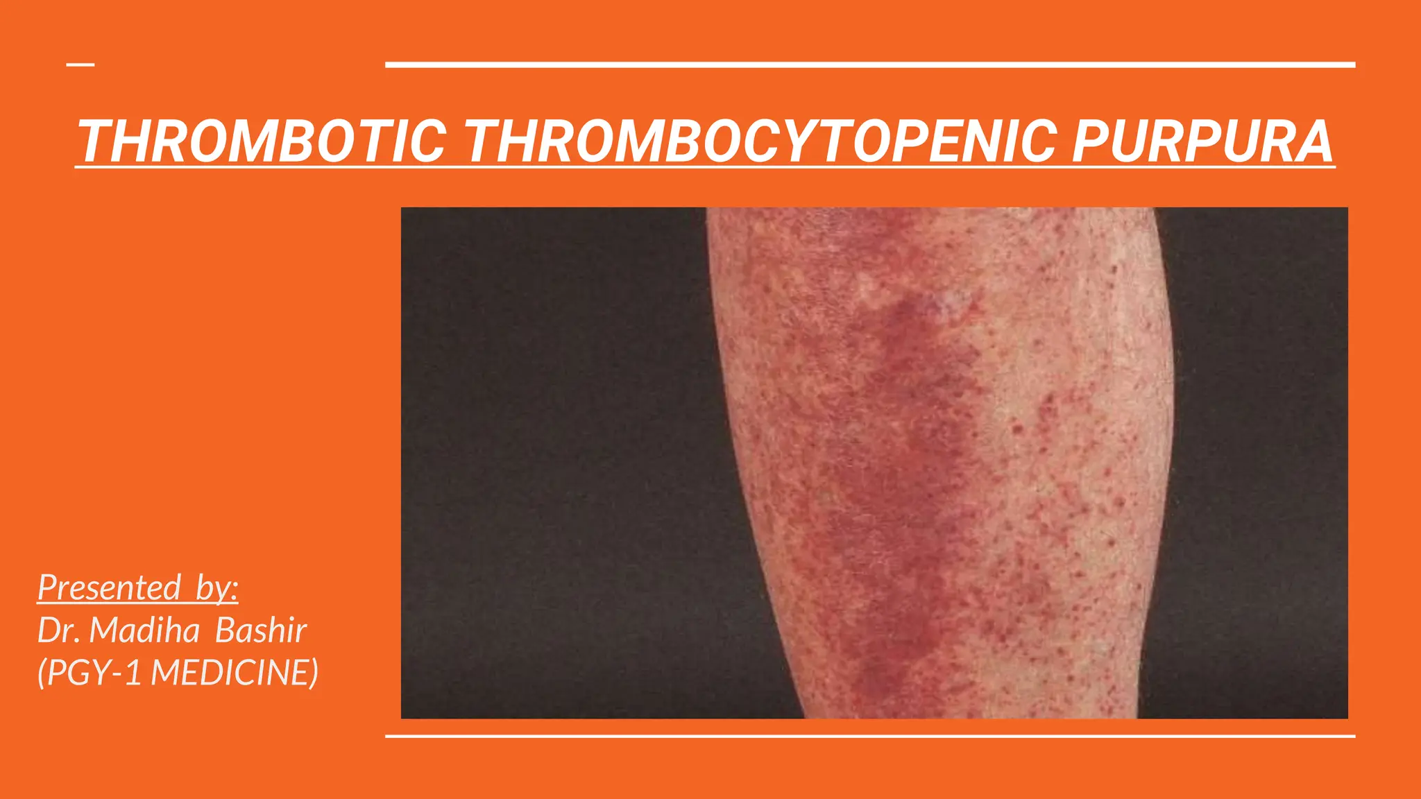 THROMBOTIC THROMBOCYTOPENIC PURPURA (4).pptx