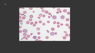 THROMBOTIC THROMBOCYTOPENIC PURPURA (4).pptx