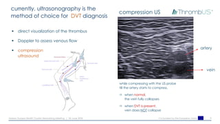 ThrombUS+ Project Presentation - June 2024 | PDF