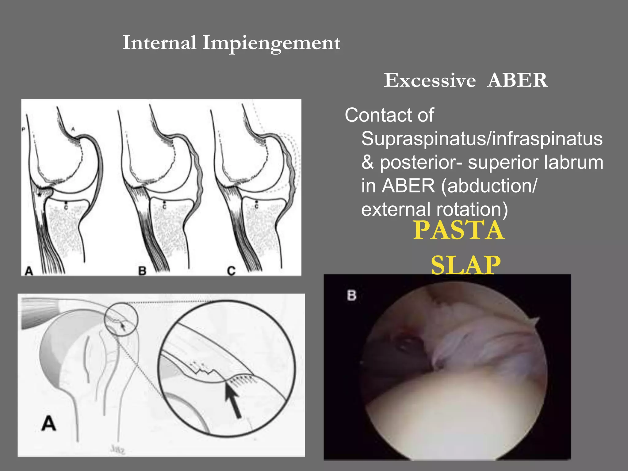Thrower's shoulder ppt | PPTX