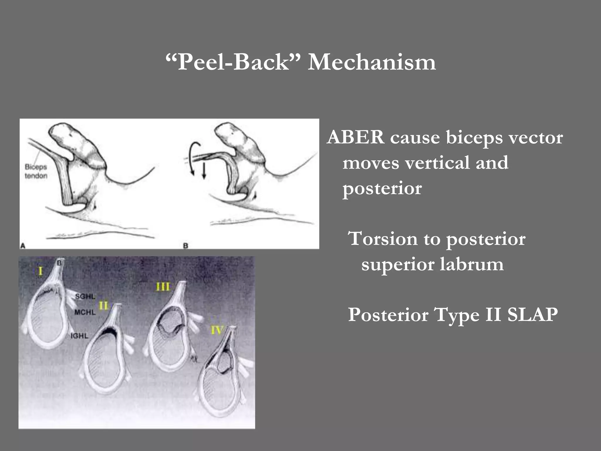 Thrower's shoulder ppt | PPTX
