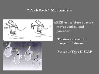 Thrower's shoulder ppt | PPT
