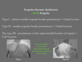 Thrower's shoulder ppt | PPT