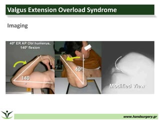 Elbow sports injuries | PPTX