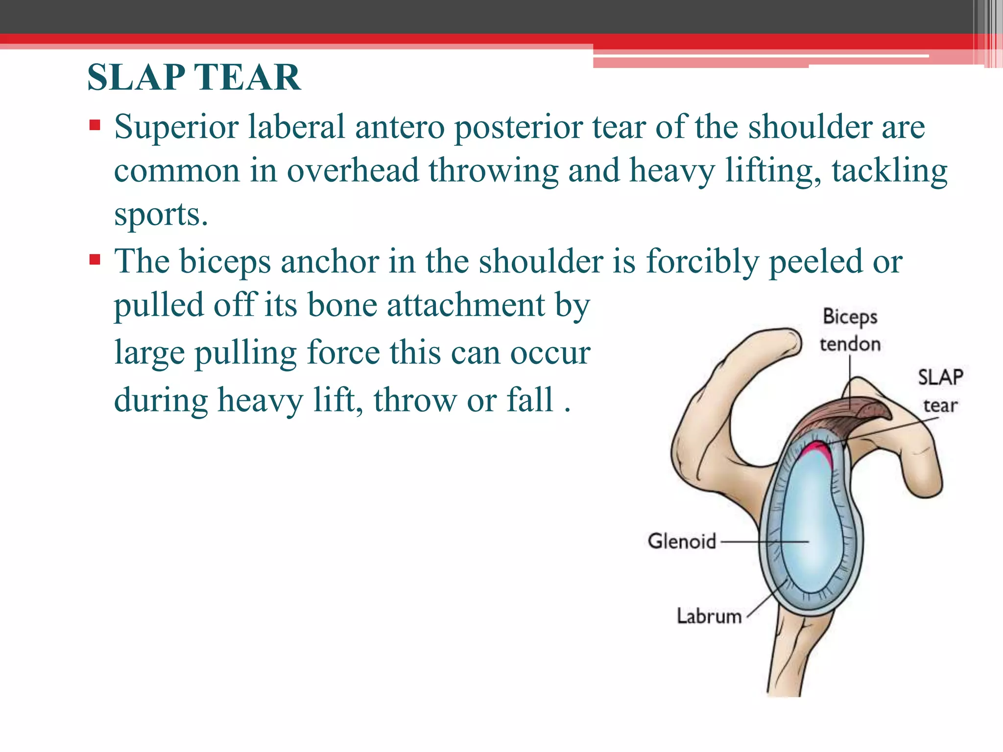 THROWING INJURIES OF UPPER LIMB - MANOJ PRASATH | PPTX