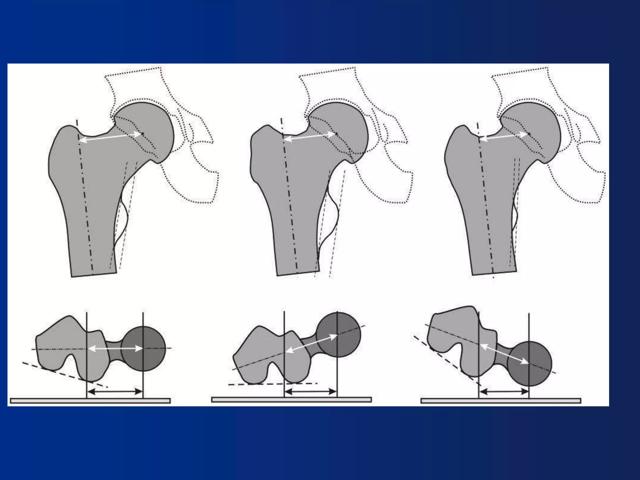 PRE OPERATIVE TEMPLATING IN TOTAL HIP ARTHROPLASTY | PPTX