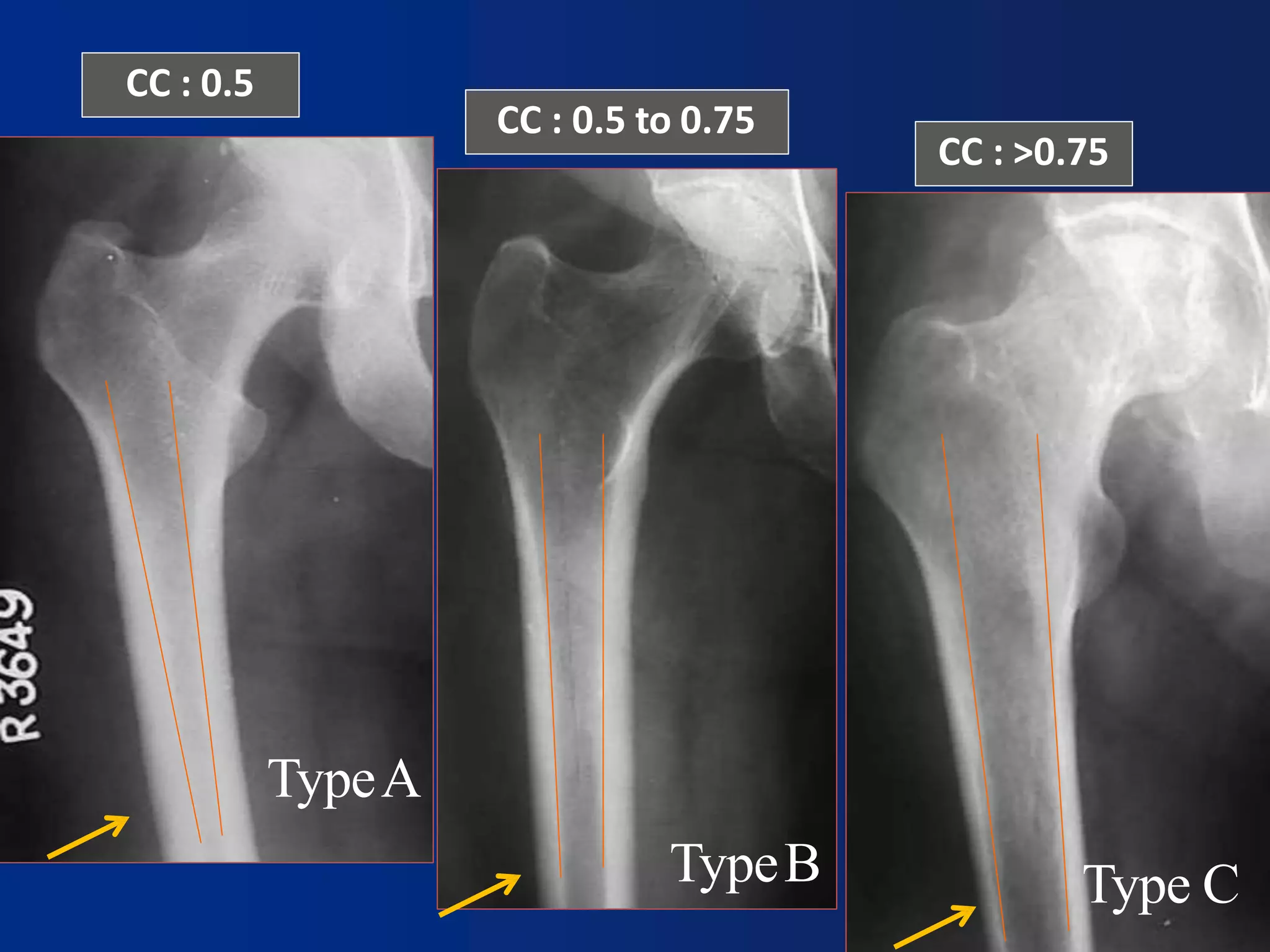 PRE OPERATIVE TEMPLATING IN TOTAL HIP ARTHROPLASTY | PPTX