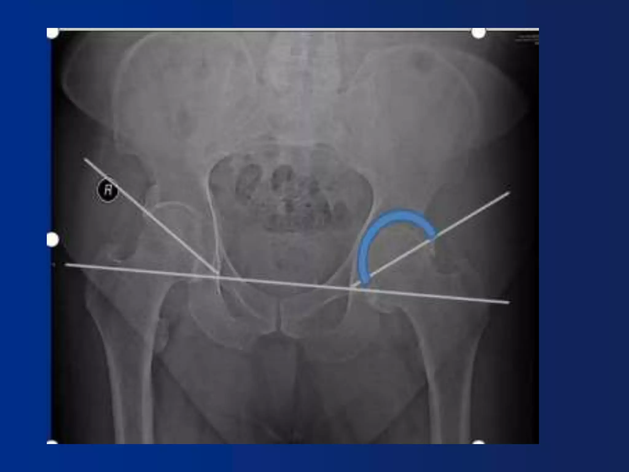 PRE OPERATIVE TEMPLATING IN TOTAL HIP ARTHROPLASTY | PPTX