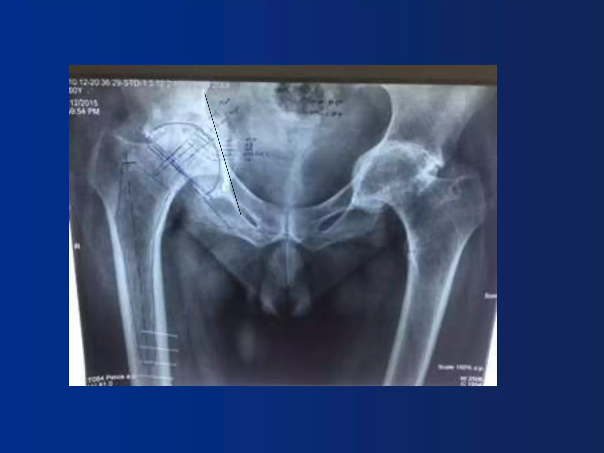 PRE OPERATIVE TEMPLATING IN TOTAL HIP ARTHROPLASTY | PPTX