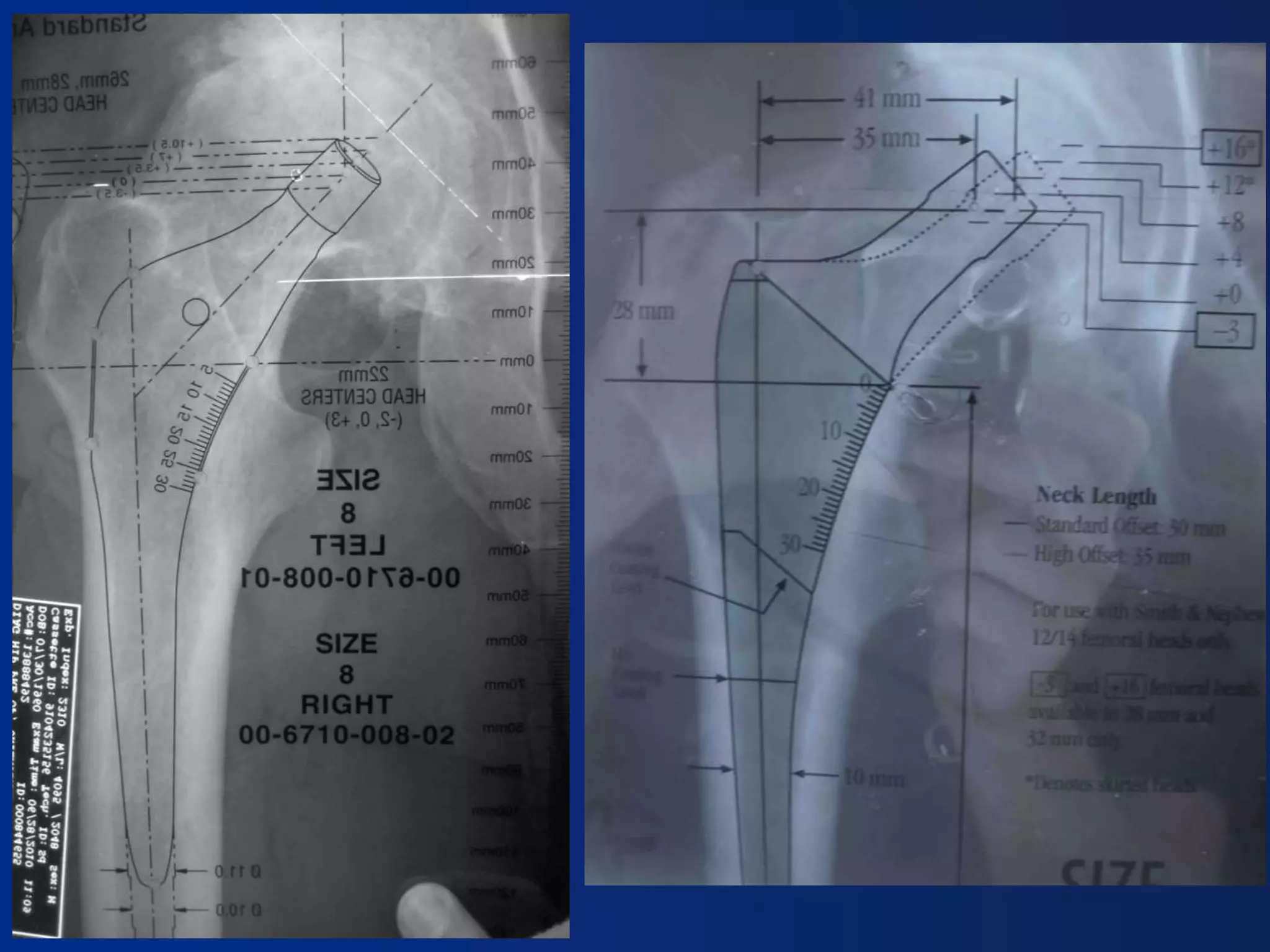 PRE OPERATIVE TEMPLATING IN TOTAL HIP ARTHROPLASTY | PPTX
