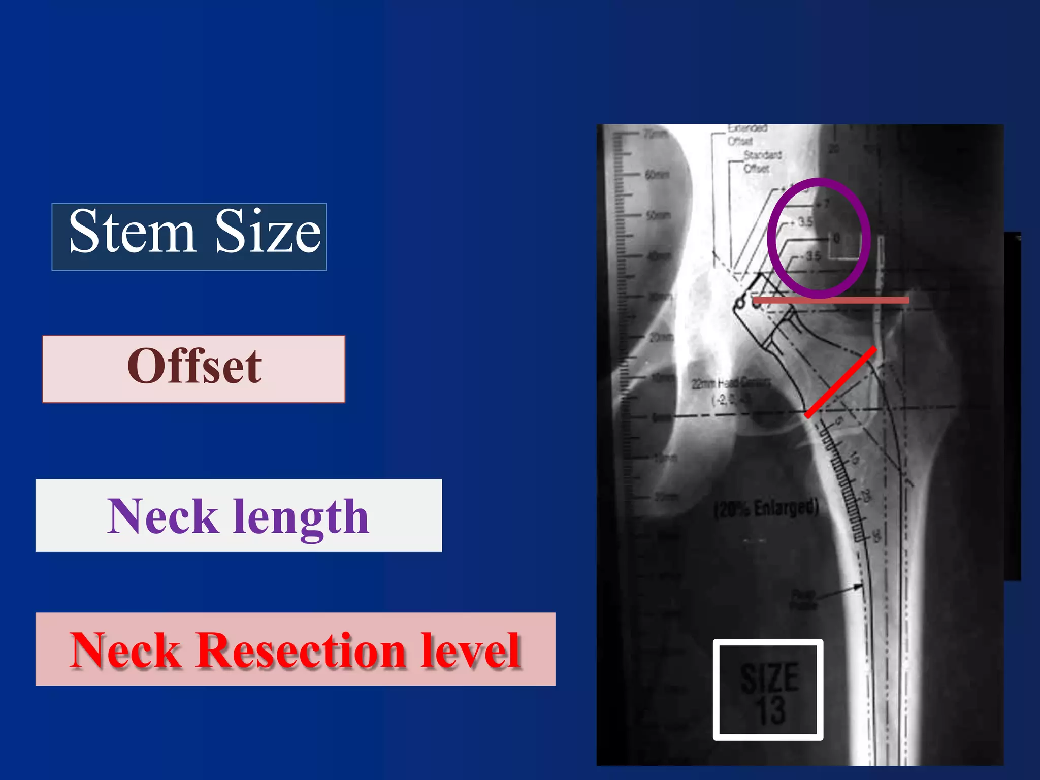 PRE OPERATIVE TEMPLATING IN TOTAL HIP ARTHROPLASTY | PPTX