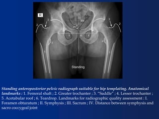 PRE OPERATIVE TEMPLATING IN TOTAL HIP ARTHROPLASTY | PPTX