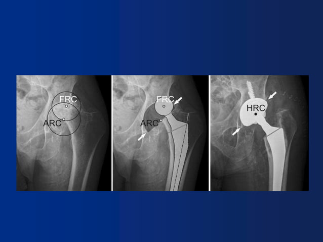PRE OPERATIVE TEMPLATING IN TOTAL HIP ARTHROPLASTY | PPTX | Bone and ...