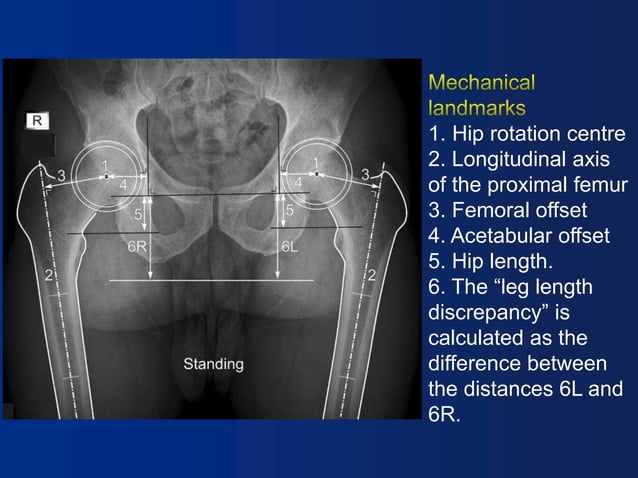 PRE OPERATIVE TEMPLATING IN TOTAL HIP ARTHROPLASTY | PPTX | Bone and ...