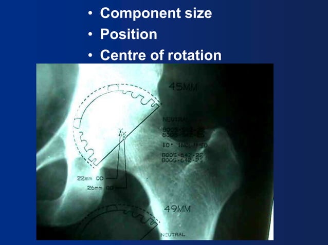 PRE OPERATIVE TEMPLATING IN TOTAL HIP ARTHROPLASTY | PPTX | Bone and ...