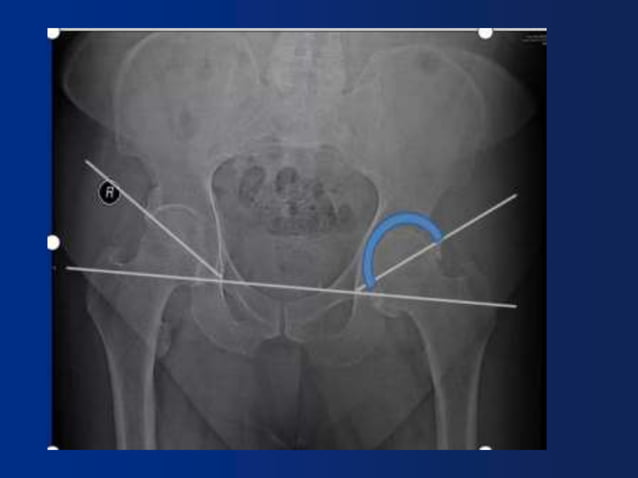 PRE OPERATIVE TEMPLATING IN TOTAL HIP ARTHROPLASTY | PPTX | Bone and ...