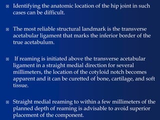 PRE OPERATIVE TEMPLATING IN TOTAL HIP ARTHROPLASTY | PPTX