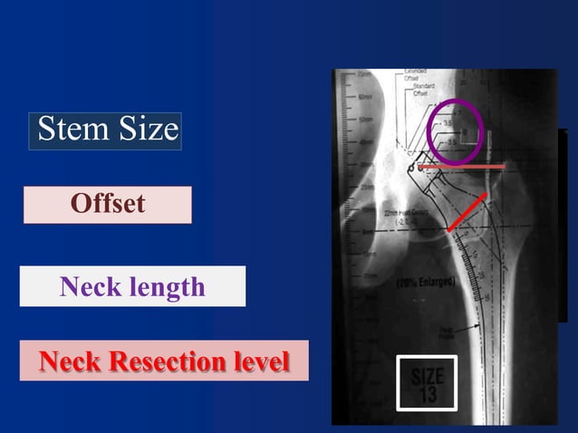 PRE OPERATIVE TEMPLATING IN TOTAL HIP ARTHROPLASTY | PPTX | Bone and ...
