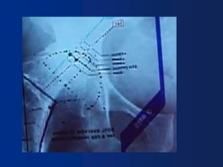 PRE OPERATIVE TEMPLATING IN TOTAL HIP ARTHROPLASTY | PPTX