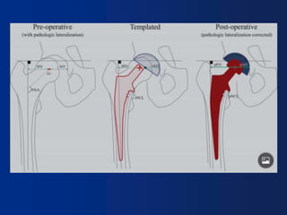 PRE OPERATIVE TEMPLATING IN TOTAL HIP ARTHROPLASTY | PPTX