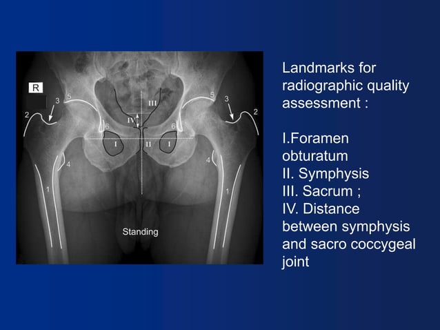 PRE OPERATIVE TEMPLATING IN TOTAL HIP ARTHROPLASTY | PPTX | Bone and ...