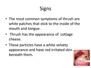 Thrush(2) | PPTX | Skin and Dermatology | Diseases and Conditions