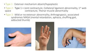Congenital Thumb Deformities | PPTX