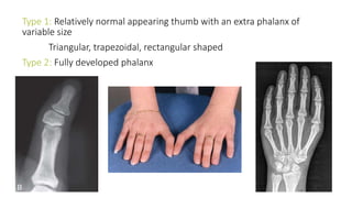 Congenital Thumb Deformities | PPTX
