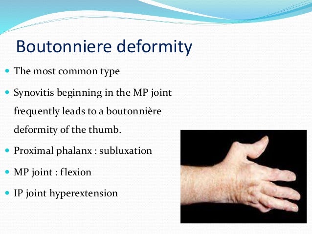 Thumb deformity