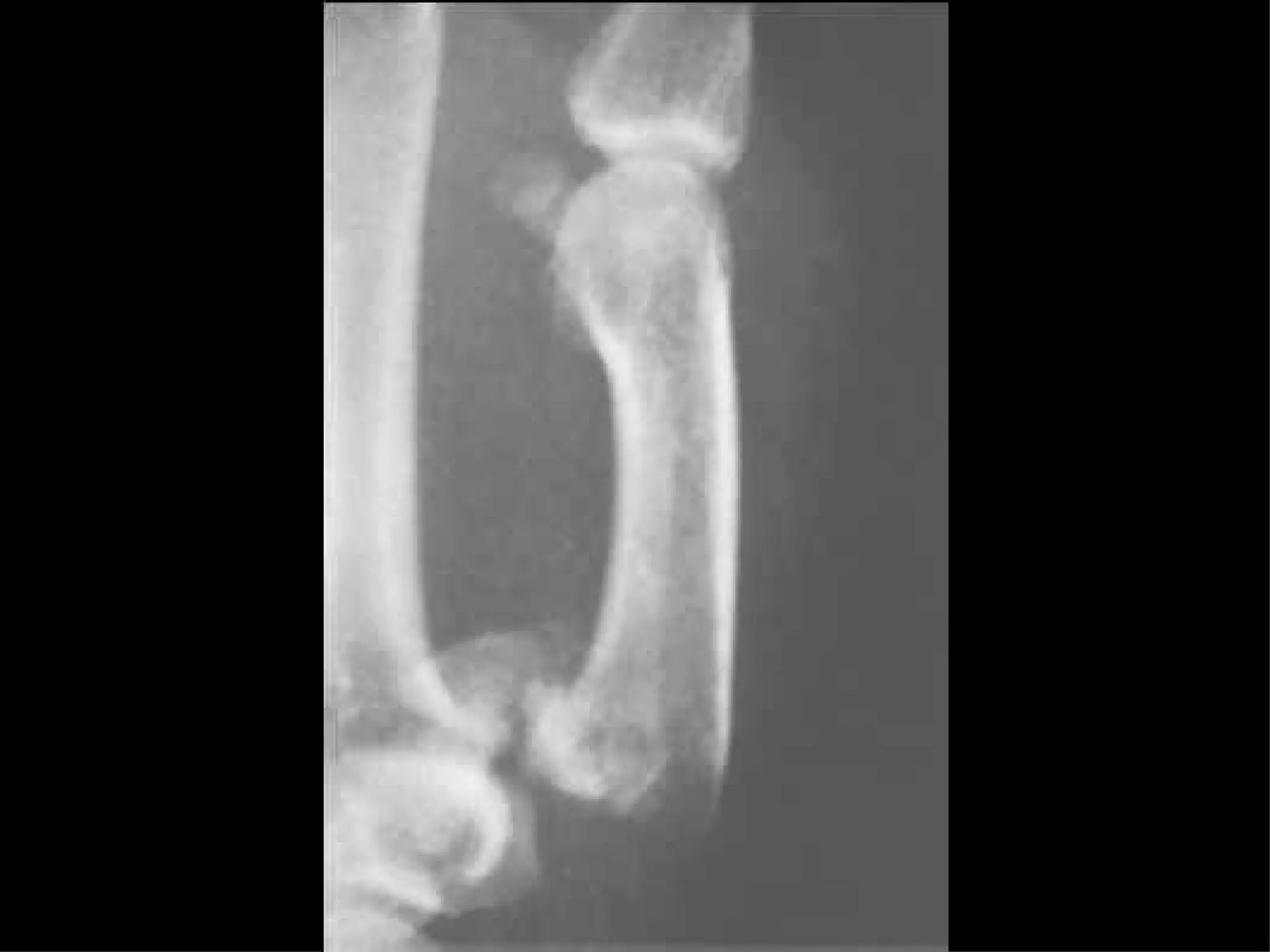 Thumb fractures | PPT | Death, Injury, or Military Conflict | Sensitive ...